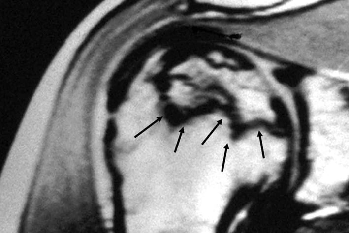 Avascular Necrosis of the Humeral Head | OrthoVellum