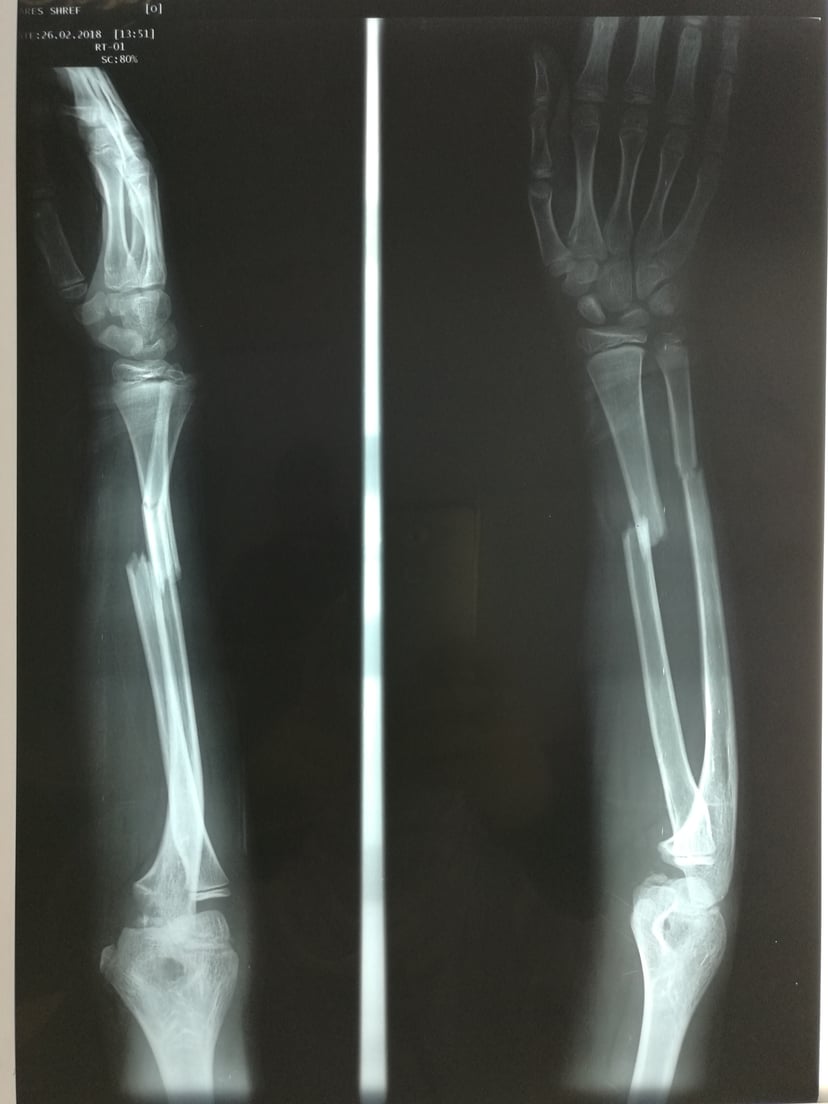 Both-Bone Forearm Fractures | OrthoVellum