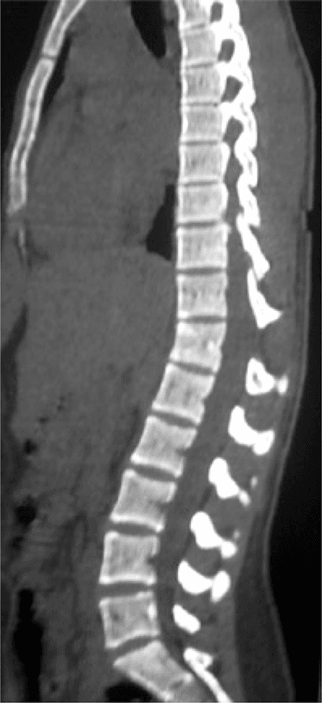 Chance Fractures | OrthoVellum