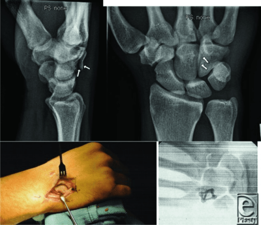 Hamate Fractures | OrthoVellum