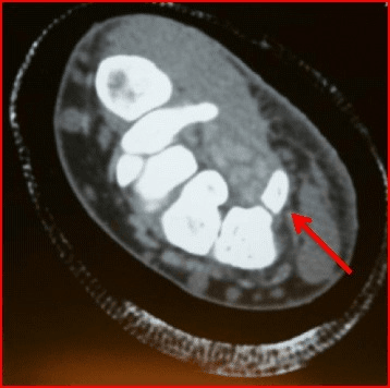 Hamate Fractures | OrthoVellum