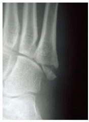 Jones Fractures | OrthoVellum