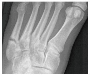 Jones Fractures | OrthoVellum