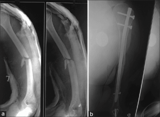 Malunion, Delayed Union and Nonunion | OrthoVellum