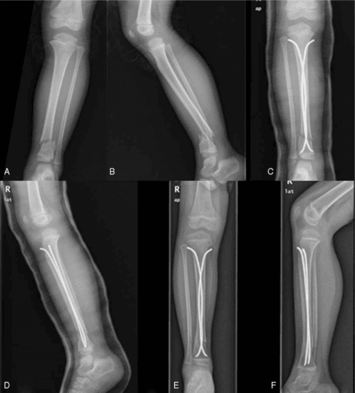 Malunion, Delayed Union and Nonunion | OrthoVellum