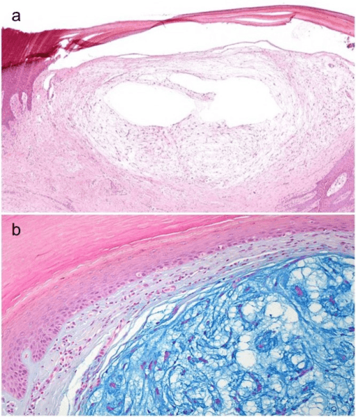 Mucous Cysts (Digital Mucoid Cysts) | OrthoVellum