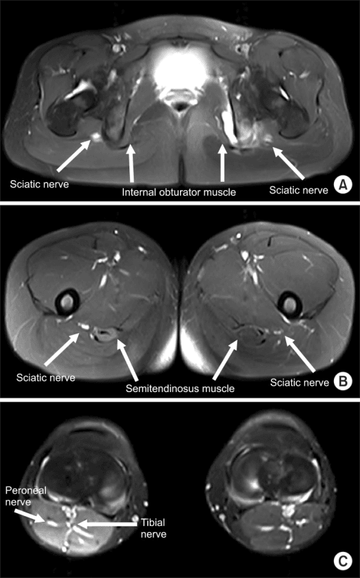 Proximal Hamstring Injuries | OrthoVellum