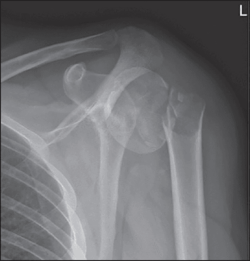 Proximal Humerus Fractures | OrthoVellum